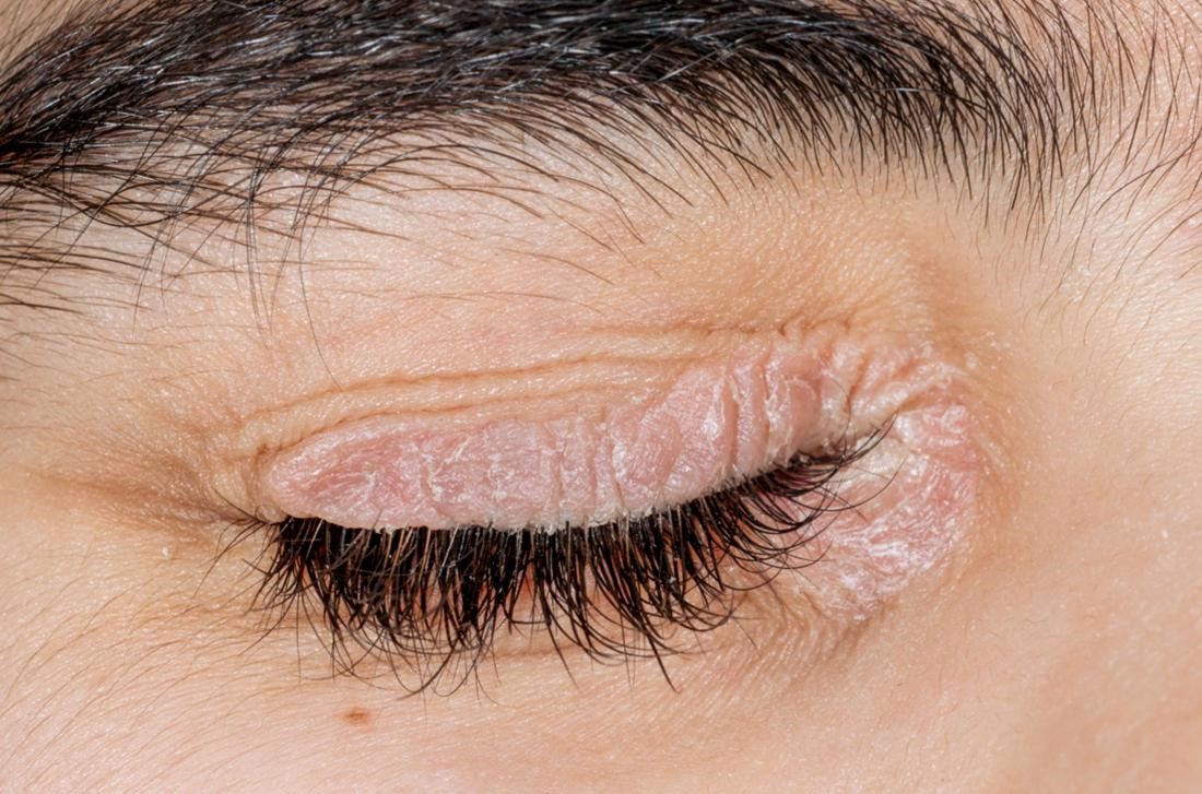 Viêm da cơ địa vùng mắt : DA LIỄU HỒNG ĐỨC